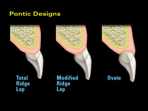 Managing Congenitally Missing or Microdontic Lateral Incisors ...